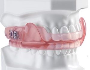 Obstructive Sleep Apnea & Treatment | Dental Arts of Atlantis